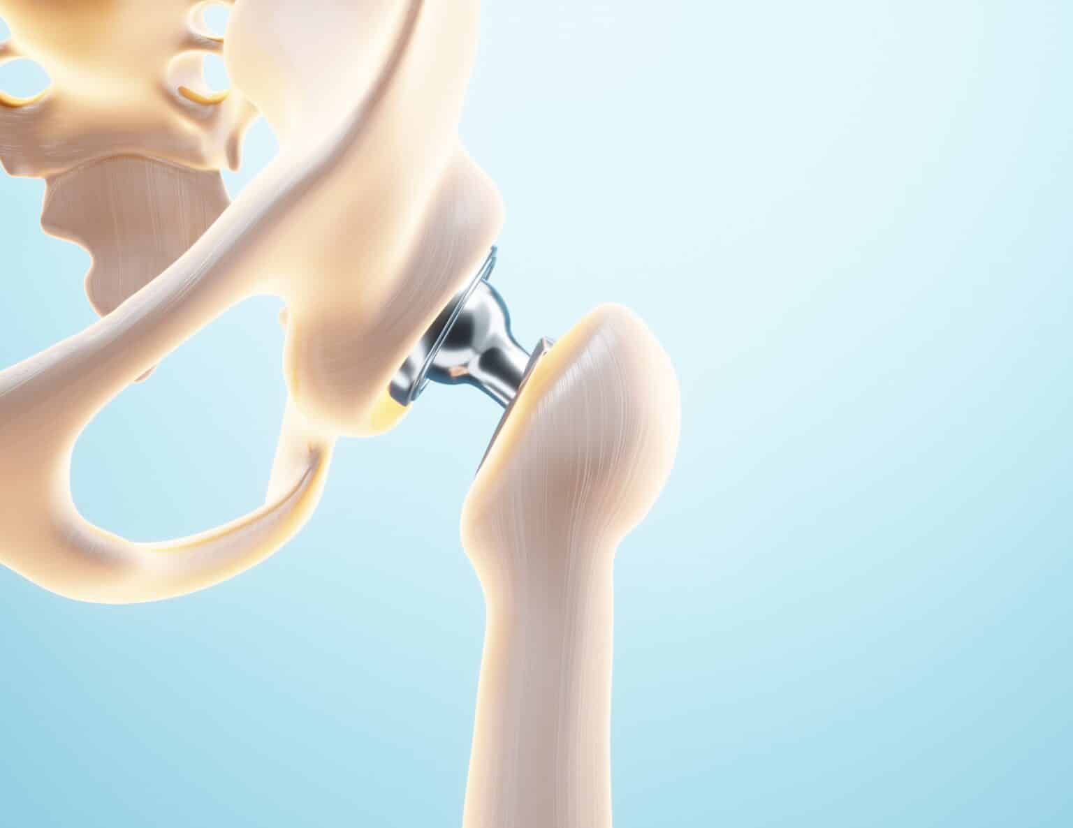 Pourquoi choisir une prothèse de hanche sur mesure ? | Paris | Inside ...