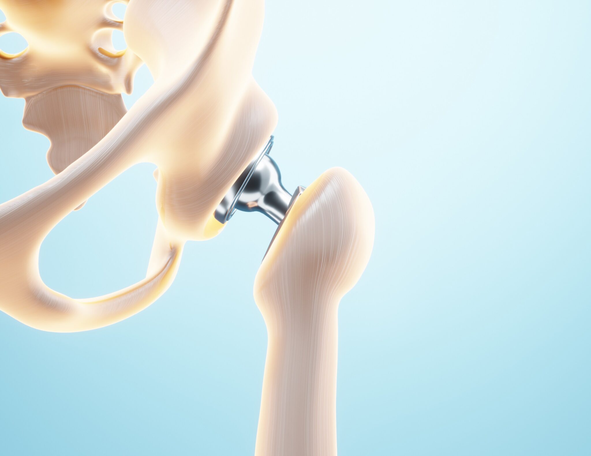 Why choose a custom-made hip prothesis ? | Paris & Lyon | Inside the Hip