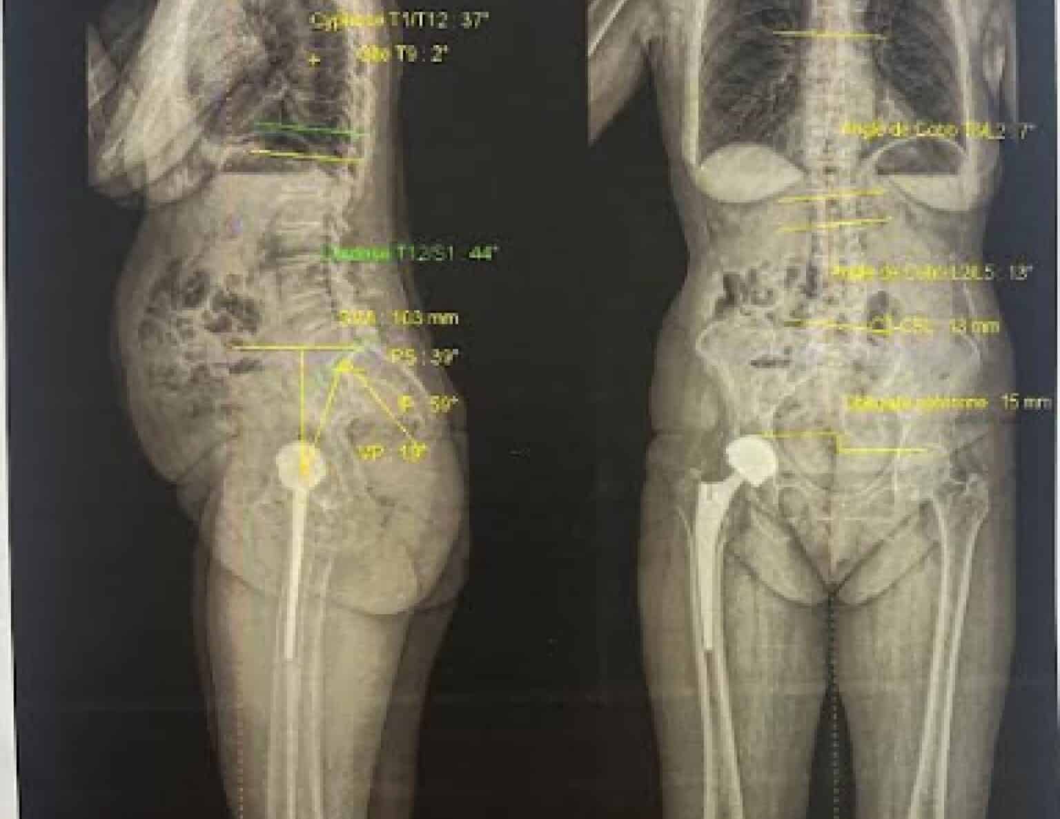 EOS Imaging or CT Scan: which 3d imaging should be performed before total hip replacement ...