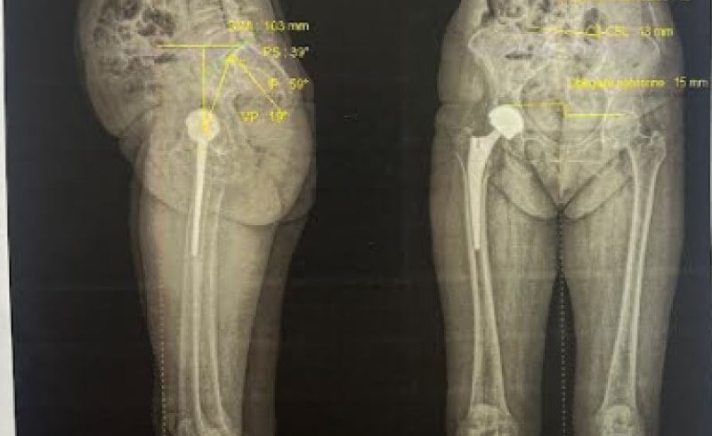 EOS Imaging or CT Scan: which 3d imaging should be performed before ...