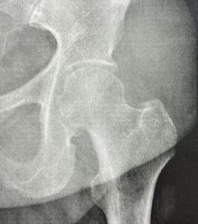 Implanting a hip prosthesis in coxopathy with normal radiographs ...