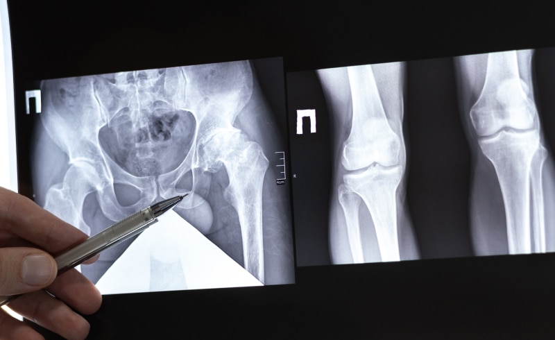 Reconnaître et traiter la coxarthrose (arthrose de hanche) | Paris et ...
